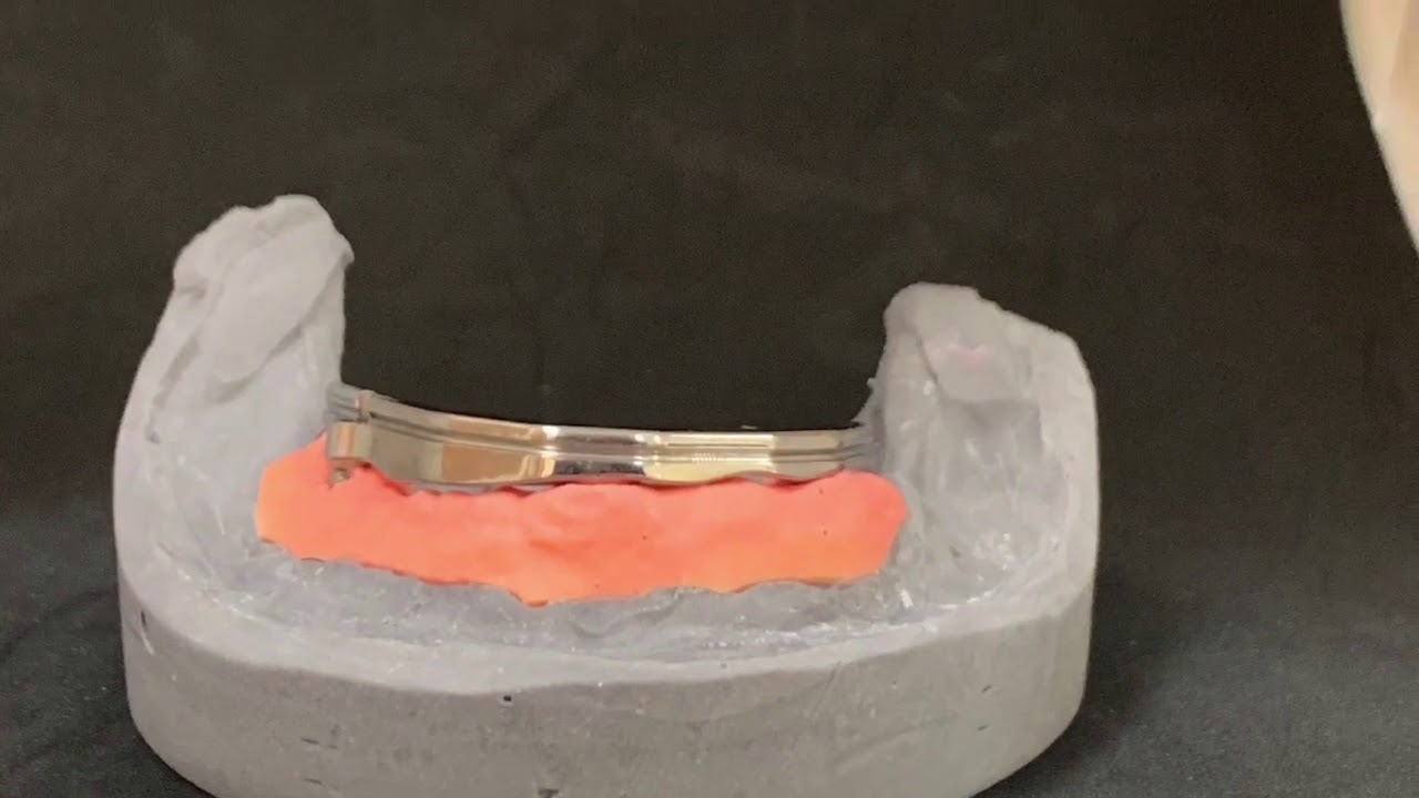 Implant bar over denture - YouTube