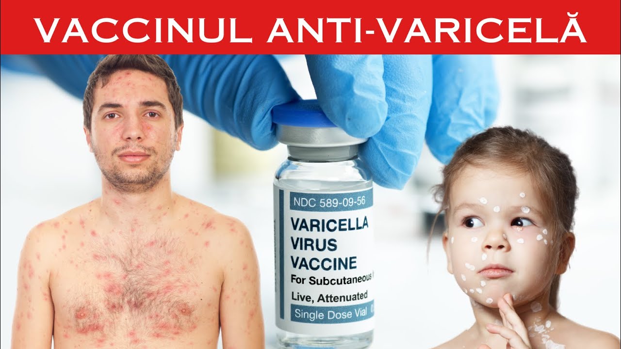 VACCINUL ANTI-VARICELA pentru COPII si ADULTI - YouTube