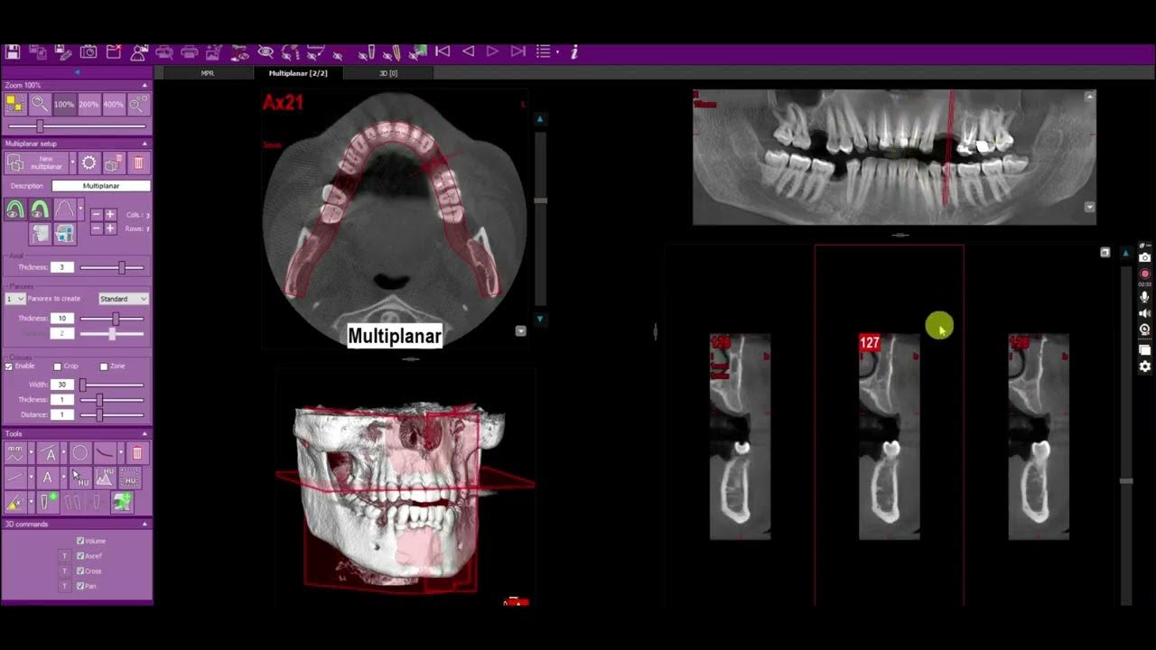 cbct in endodontic , part 1 Dr Malek Ashkar - YouTube