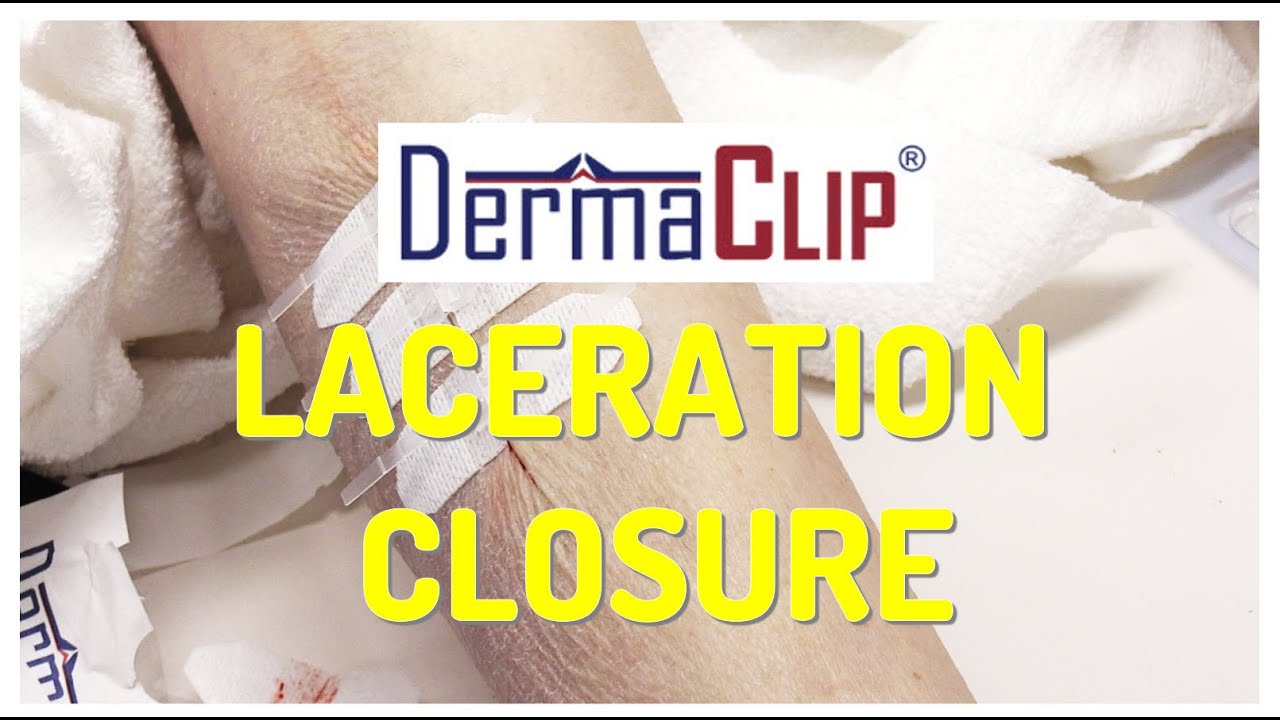 DermaClip Wound Closure Demonstration - YouTube