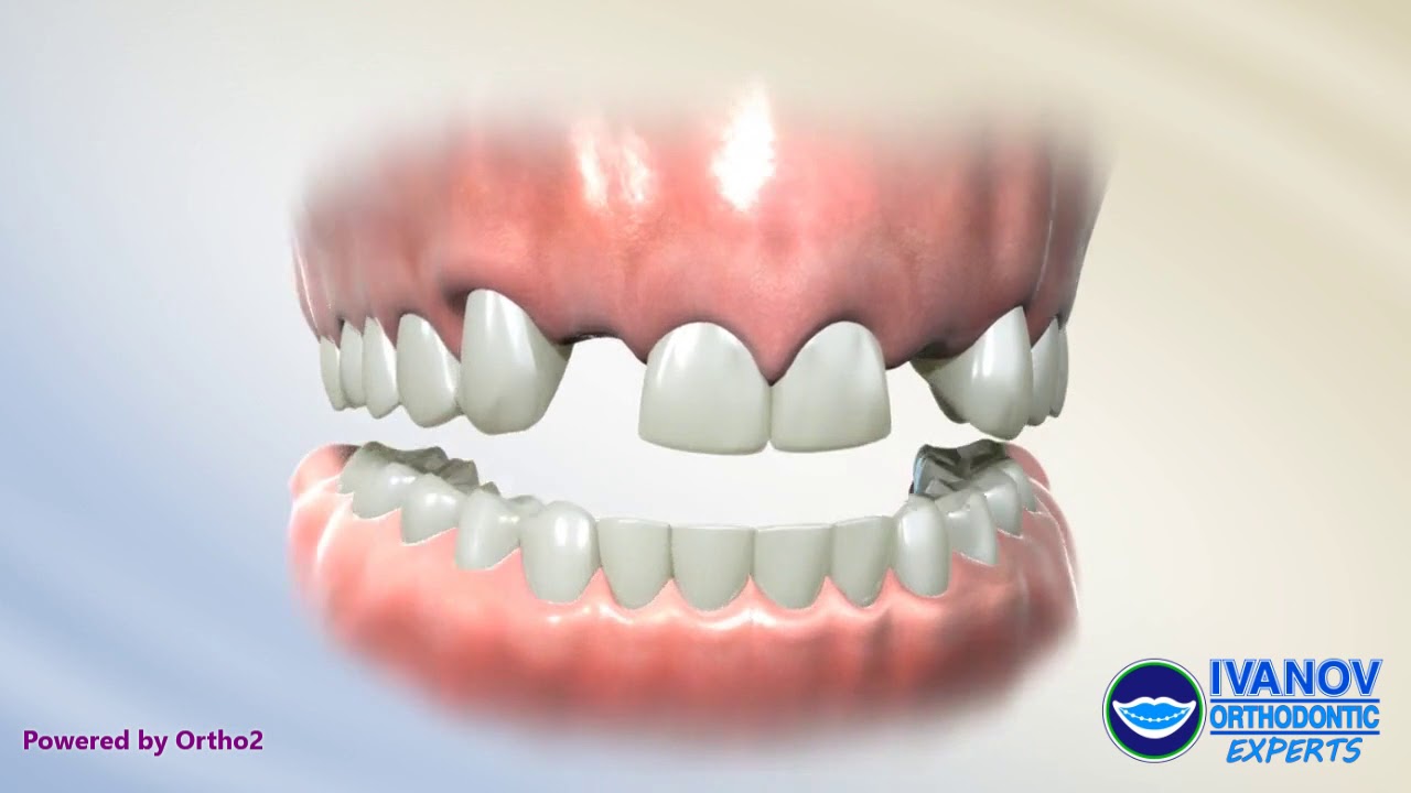 Space Regaining Appliance - YouTube