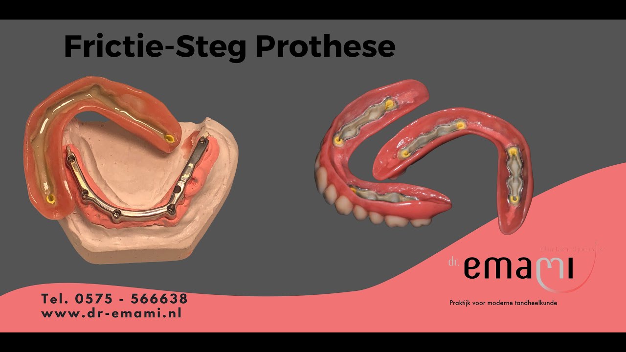 Gaumenfreie Prothese, Frictie Steg Prothese, Prothese auf Implantaten ...