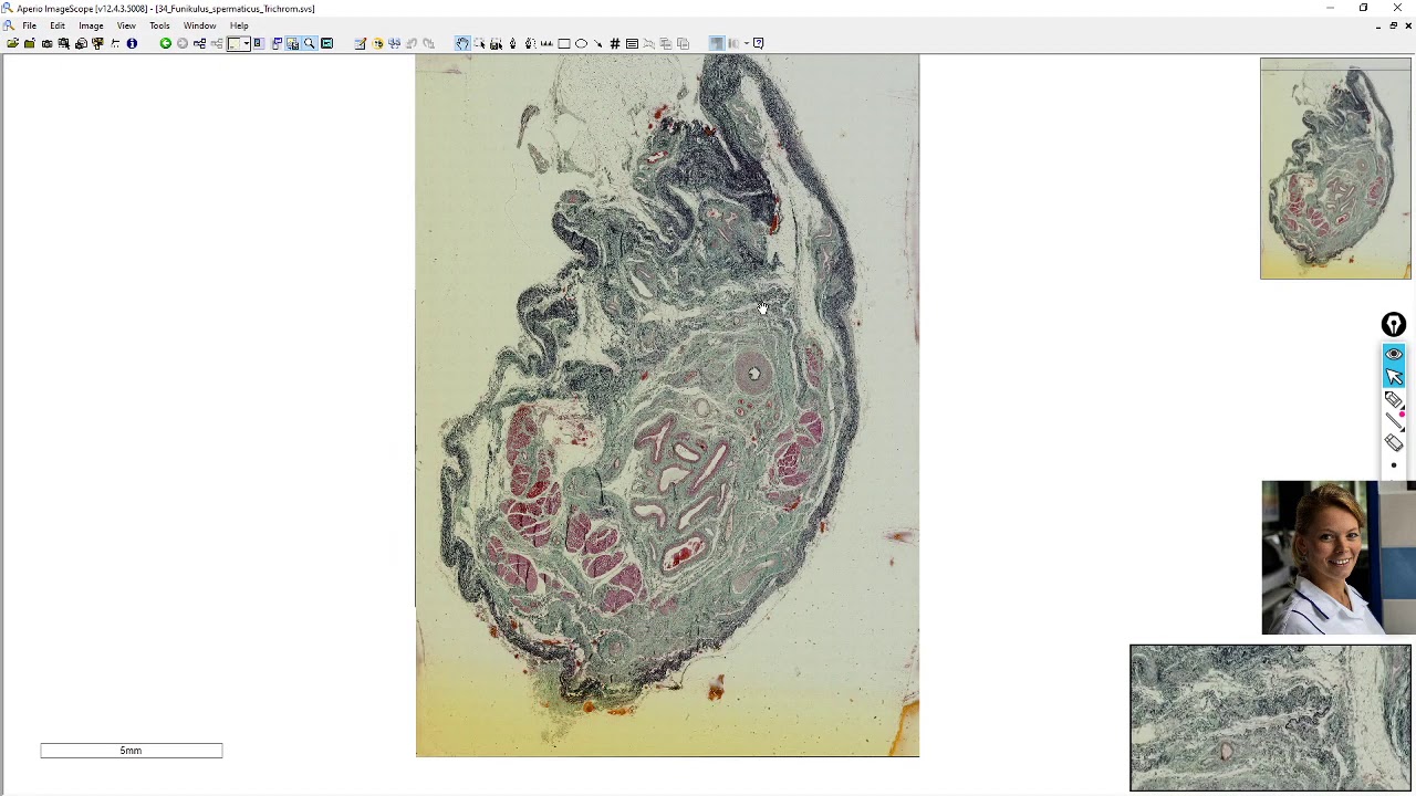 ductus deferens (chámovod) - funiculus spermaticus (semenný provazec ...