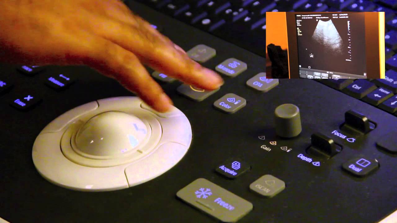 B Mode In Ultrasound Youtube