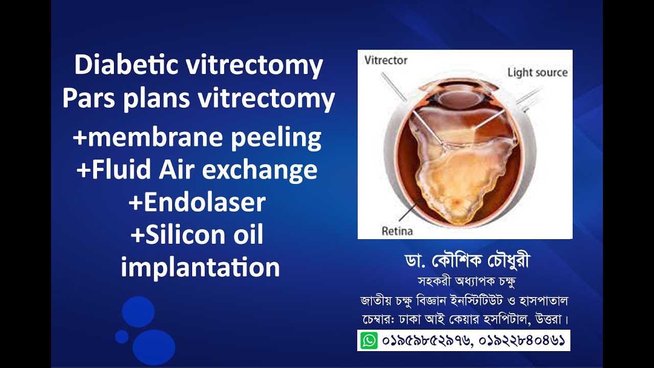 Diabetic vitrectomy Pars plans vitrectomy +membrane peeling +Fluid Air ...