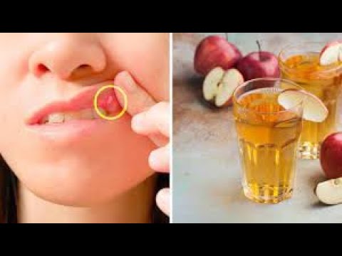 See How an Apple Can Get Rid of Your Canker Sores Naturally - YouTube