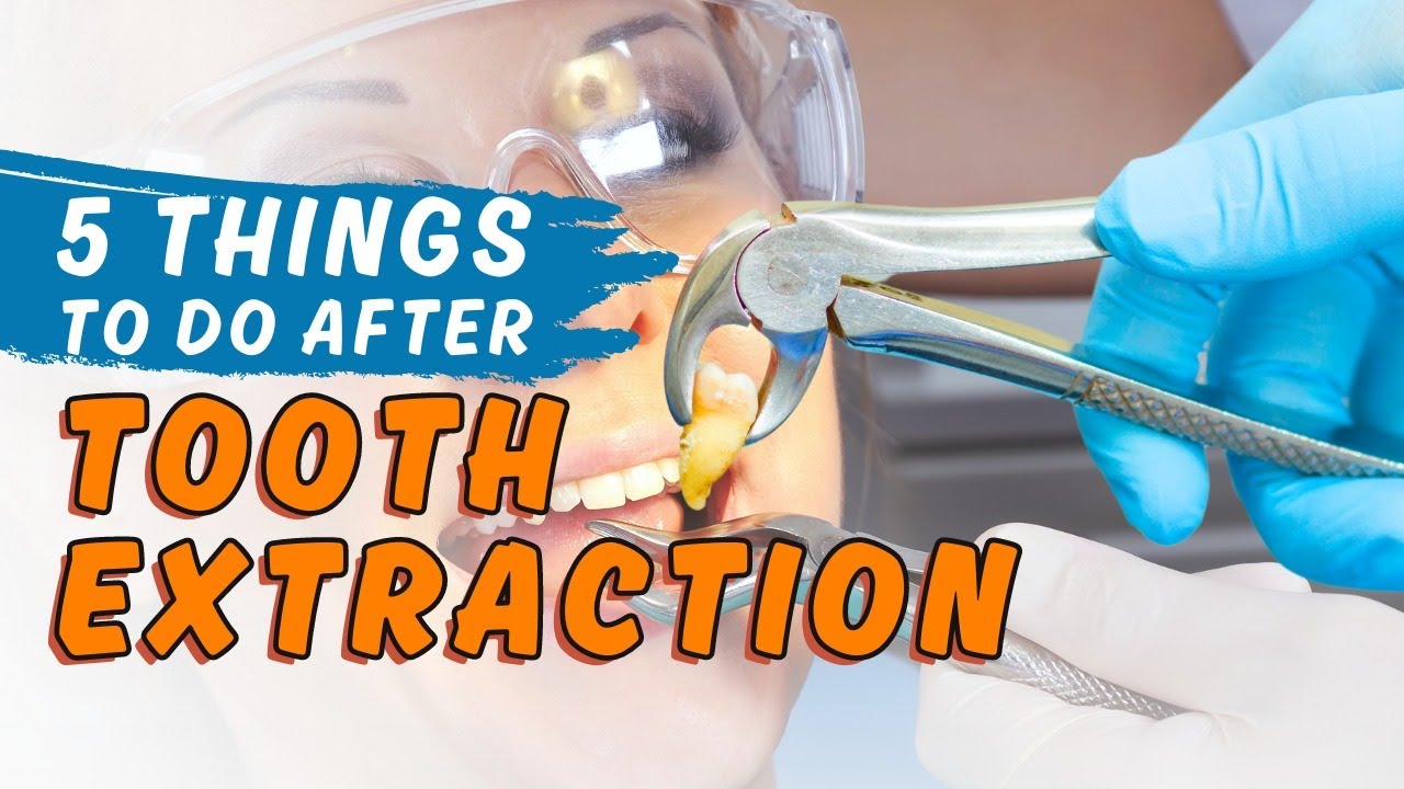 5 Things To Do After Tooth Extraction | Orthosquare Dental Clinic ...