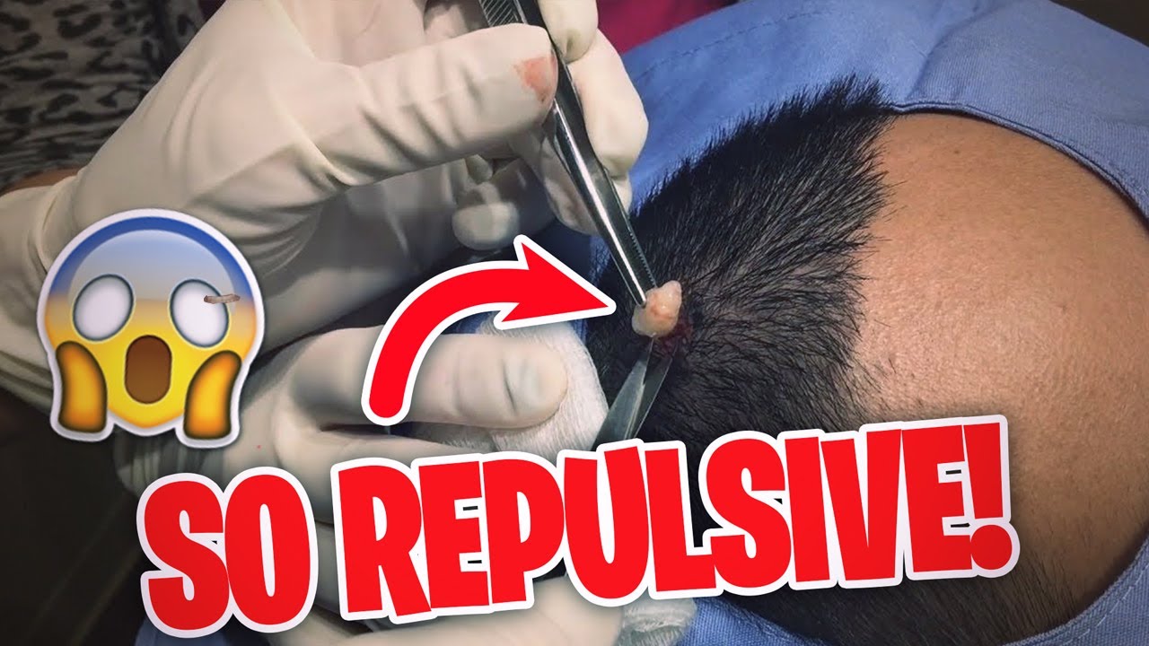 10 Of The Most Repulsive Moments On Dr Pimple Popper ๐๐ฆ Youtube
