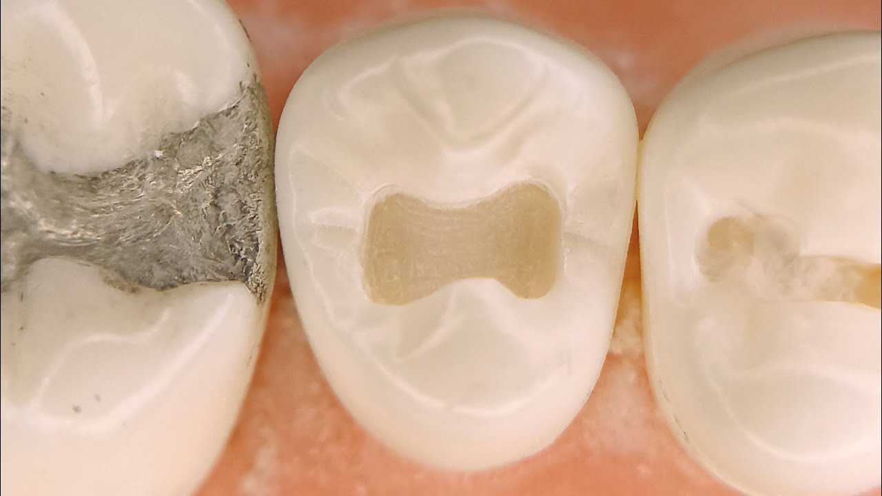 class I upper 5 cavity preparation ((principles of cavity preparation ...