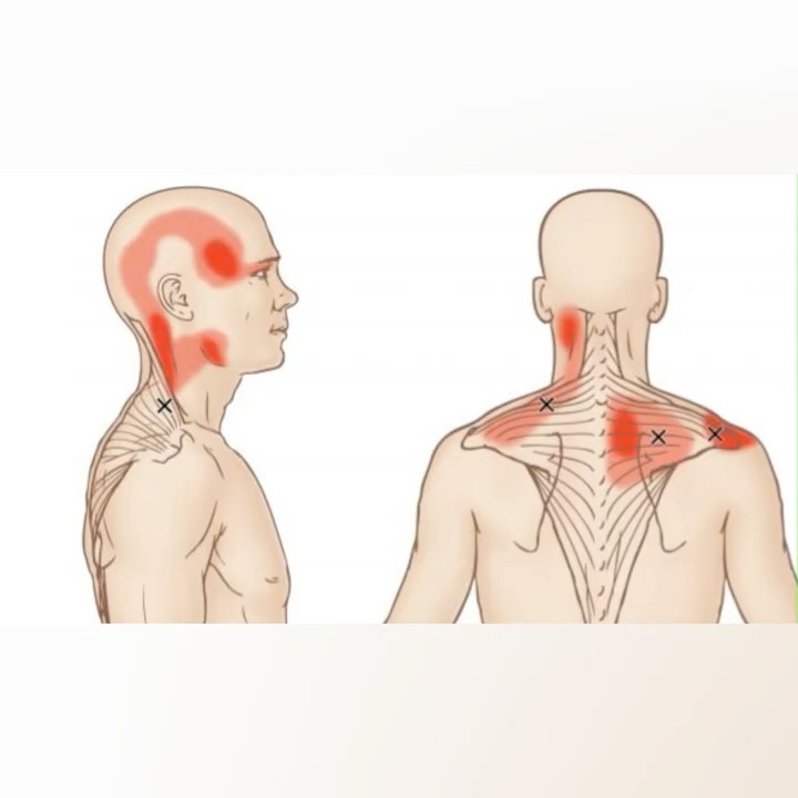 Stretch Away Neck and Shoulder Tension! - Trapezius Muscle Explained ...