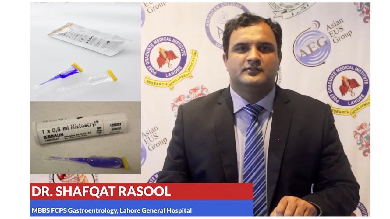 6 Dr shafqat Rasool Fundal varix Histoacryl injection - YouTube