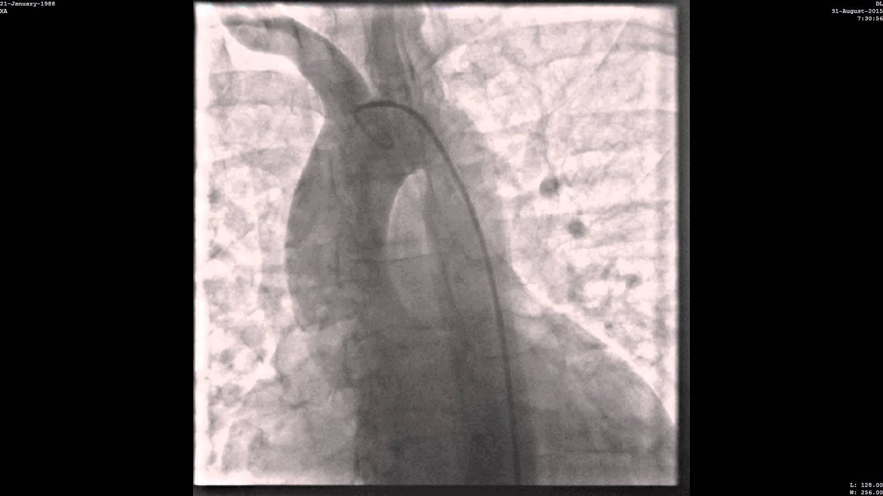 Cardiac Catheterization/Angiogram - YouTube