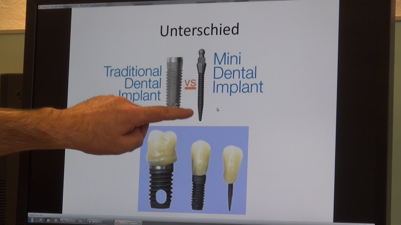 Erfolgreiche Mini-Implantate für den zahnlosen Unterkiefer - YouTube
