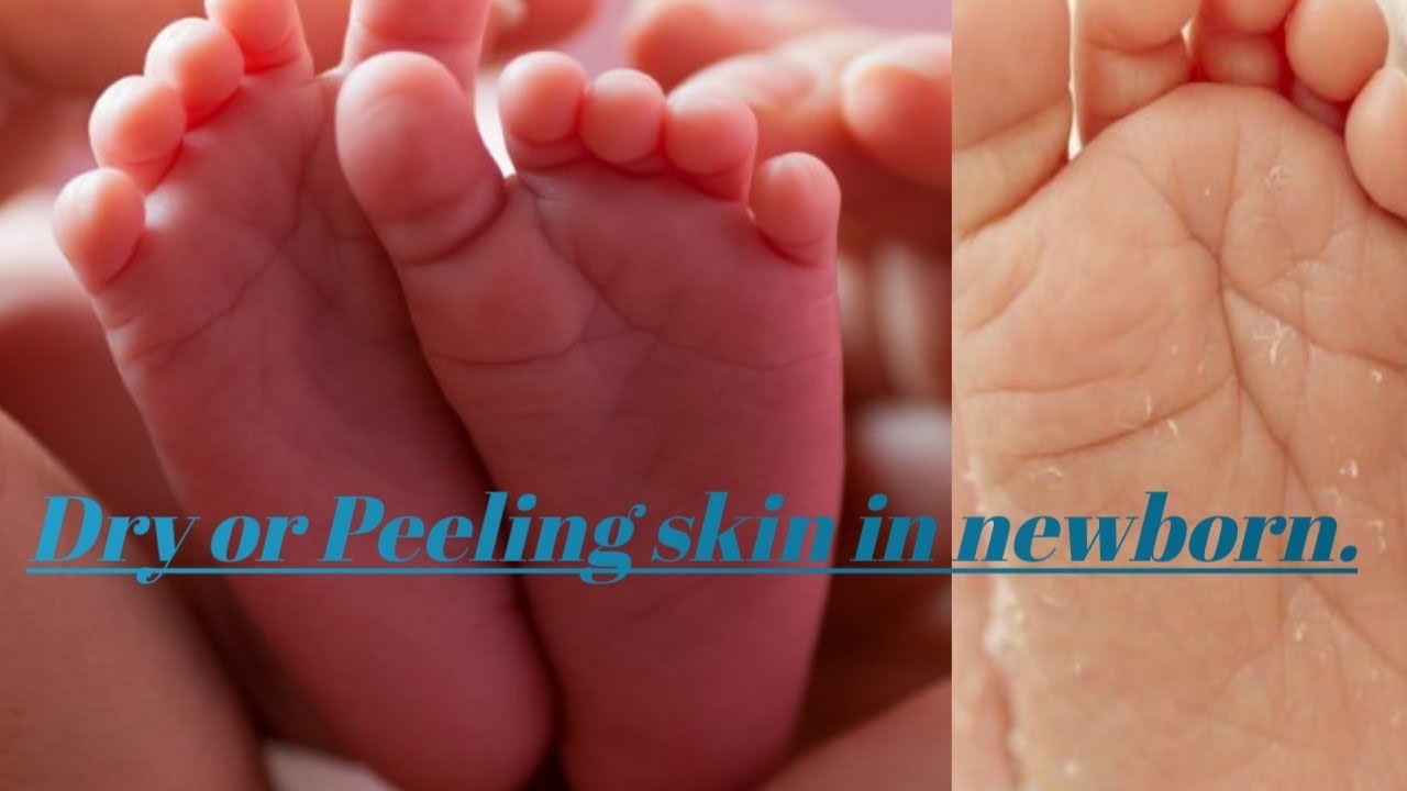 Why newborn having dryness or Peeling in their skin.(IN ENGLISH) - YouTube