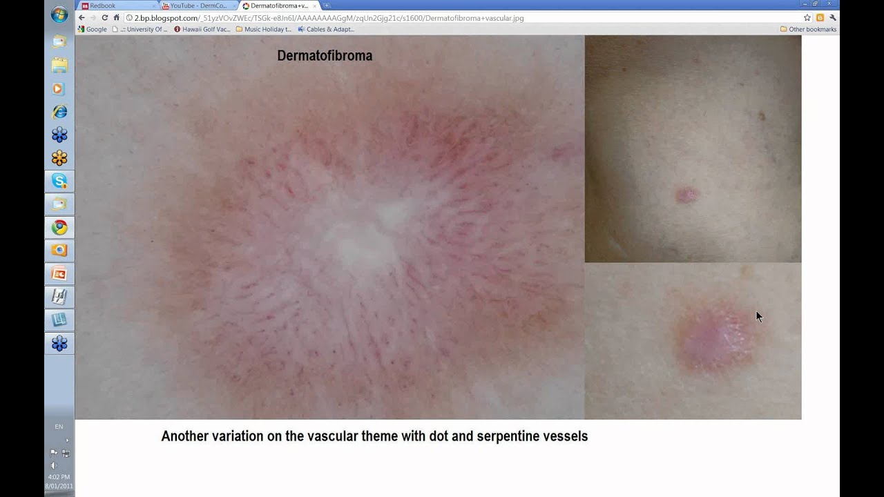 Dermoscopy Made Simple - Dermatofibroma - YouTube