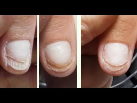 Онихолизис ч. № 3 Продолжаем лечение онихолизиса. - YouTube