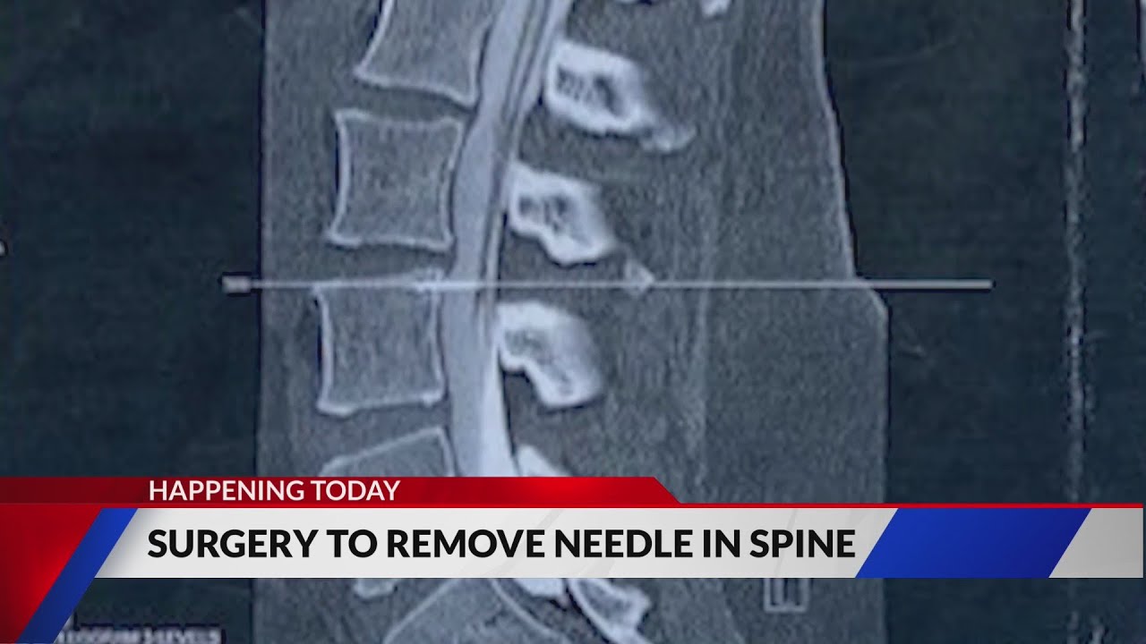 Illinois woman having surgery to remove needle in spine today - YouTube