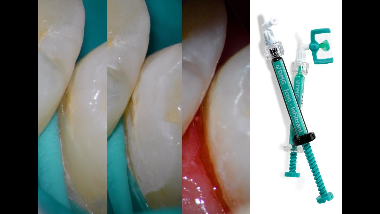 Proximal Resin Infiltration - ICON (clinical case) - YouTube