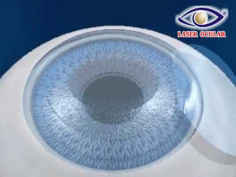 🥇 - Cirugía de los Ojos LASIK | LÁSER OCULAR ® - Clínica de Ojos - YouTube