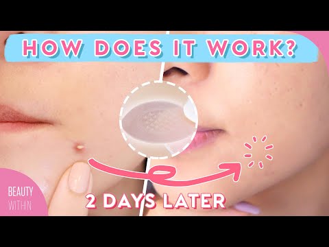Do Pimple Patches Help Clear Breakouts? Hydrocolloid vs Microdarts ✨