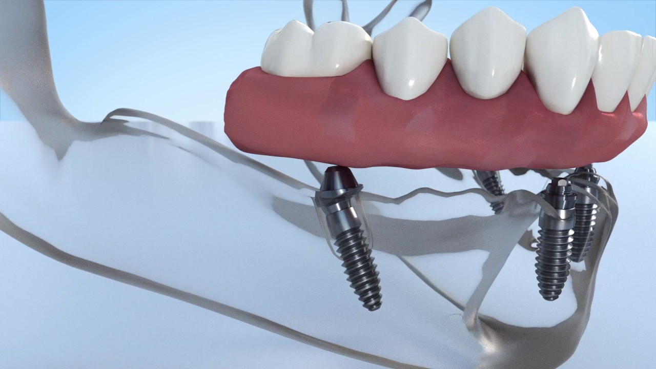 New DESS Multi-unit® angulated abutment - YouTube