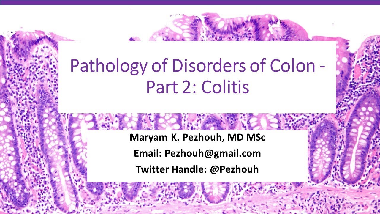 Part 2 of Pathology of Colonic disorders- Colitis - YouTube