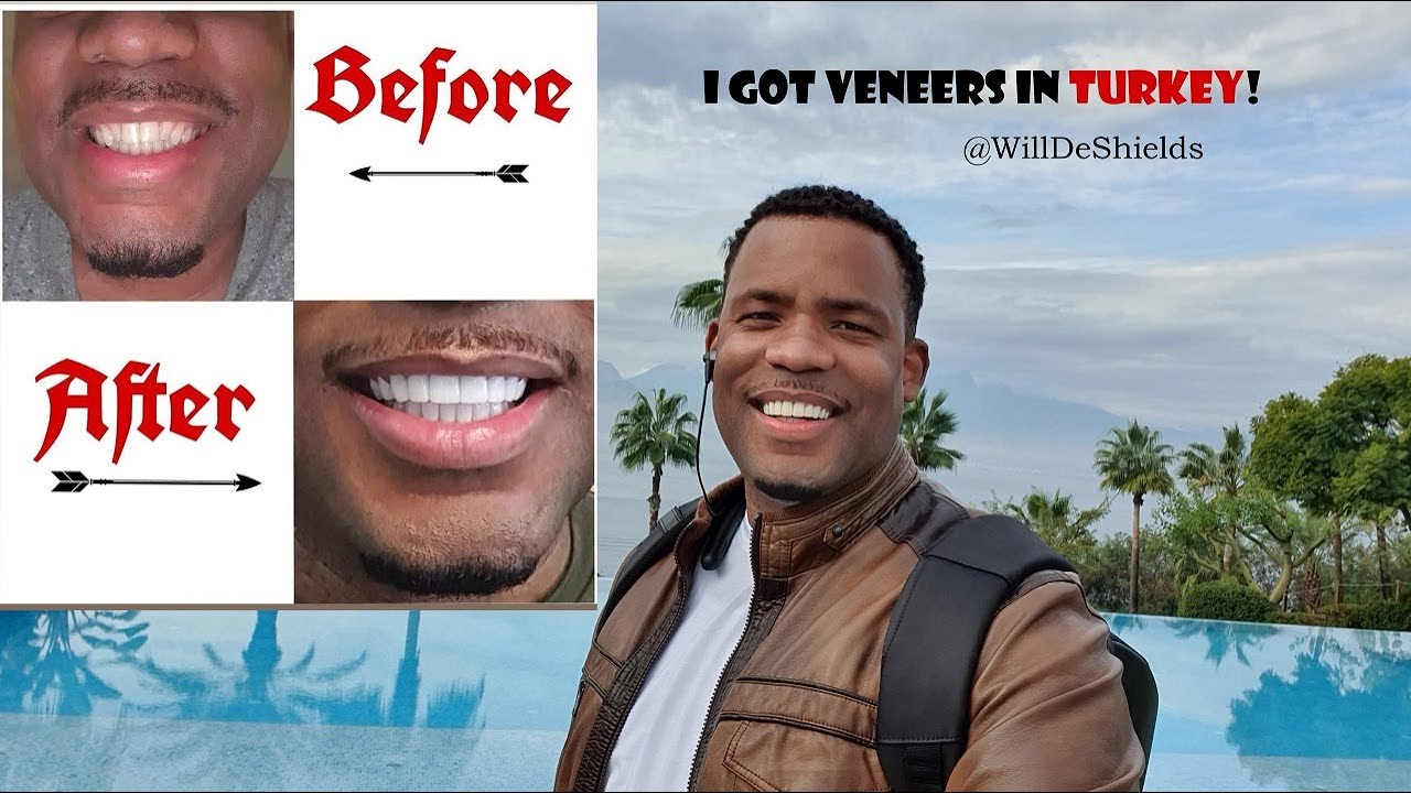 I went to Turkey to get my teeth done | My Veneers Experience - YouTube