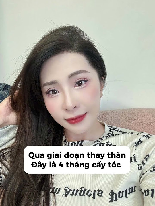 DIỄN VIÊN QUỲNH NGA CẤY TÓC HẠ TRÁN CAO SAU 2 NĂM | Hair Transplant - YouTube