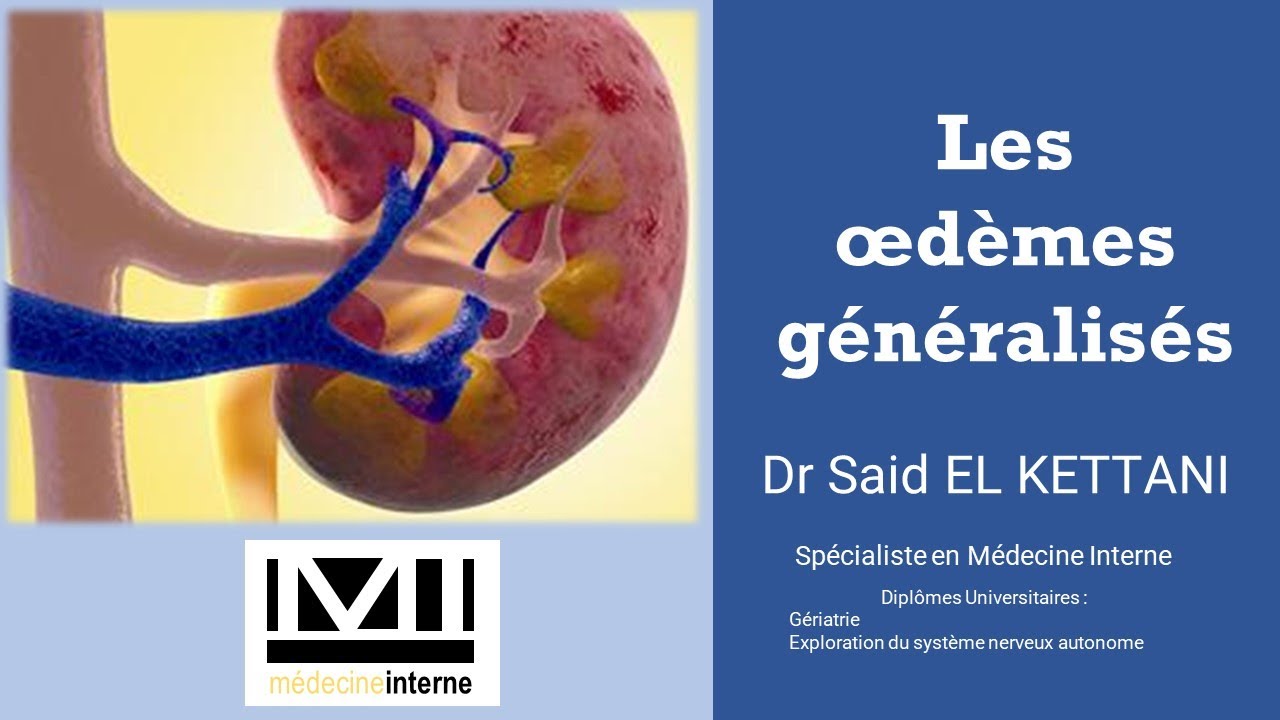 Les œdèmes généralisés : Ce que Vous Devez Absolument Savoir - YouTube