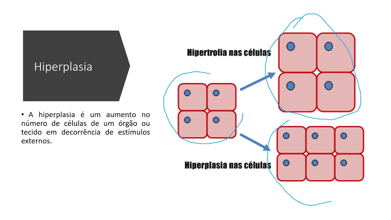 Aula 3 Hipertrofia e Hiperplasia audio - YouTube