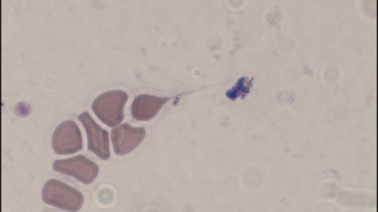 Lyme Blood: Borrelia giemsa stained - YouTube