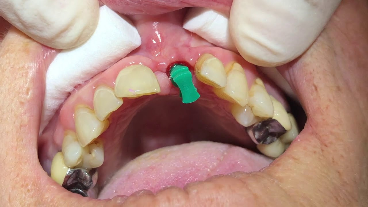 prise d'empreintes pour couronne sur implant - YouTube