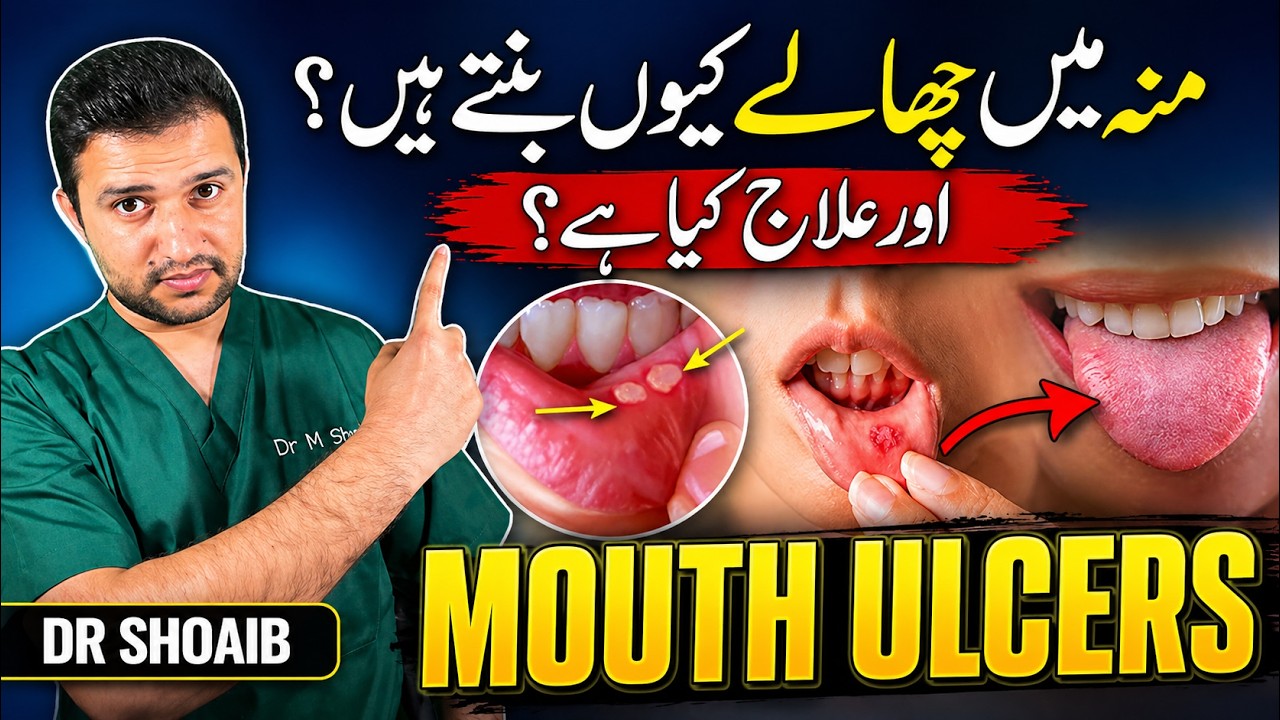 How To treat Mouth Ulcers and Prevent them In Urdu| मुंह के छाले - YouTube