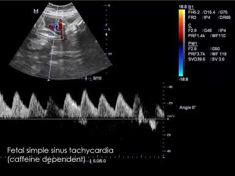 CASE 531 Fetal simple sinus tachycardia caffeine dependent
