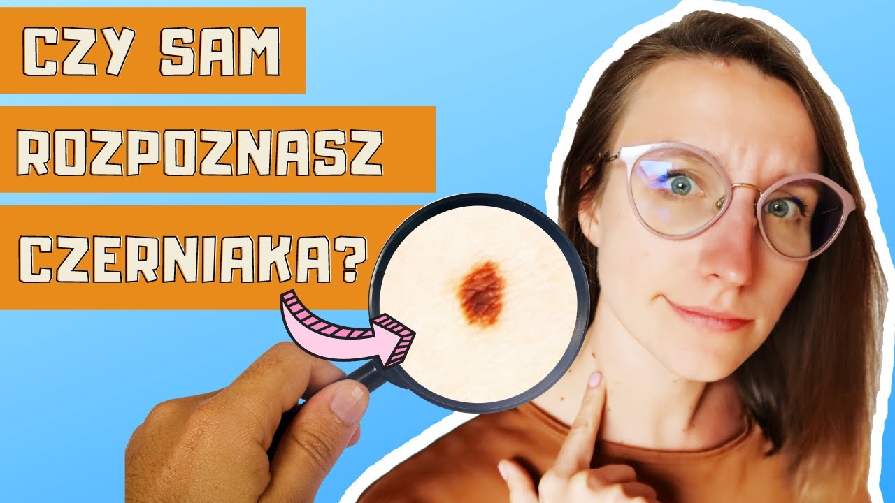 Rak skóry, czerniak – jak wygląda? 4 MITY o czerniaku! Pieprzyki na ...