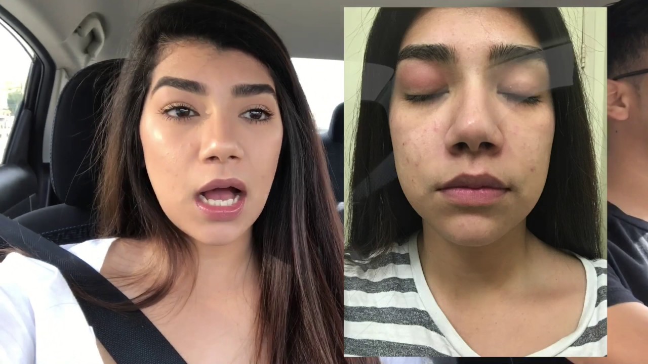 Waking Up With A Swollen Eyelid Going To The Morphe Store waking-up-with-a-swollen-eyelid-going-to-the-morphe-store