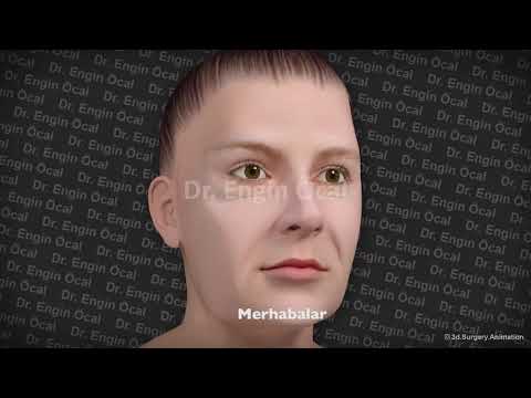 Face Lift - Yüz Germe Ameliyatı Nasıl Yapılır?