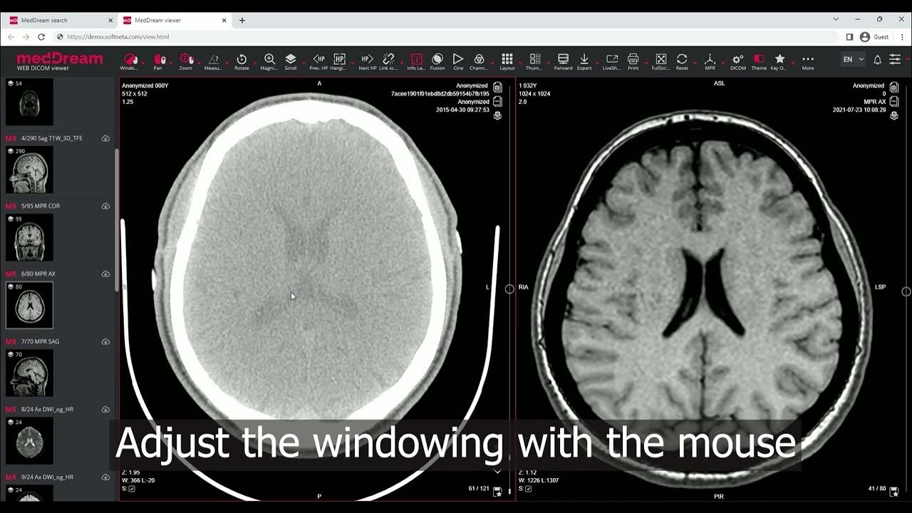 MedDream DICOM Viewer: link scrolled series - YouTube