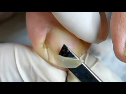 Tough Toenails Trim | Perfectly trimmed toenails, very clean | extra ...