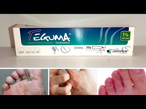 مرهم تيكوما لعلاج فطريات الجلد واكزيما و بهاق - YouTube