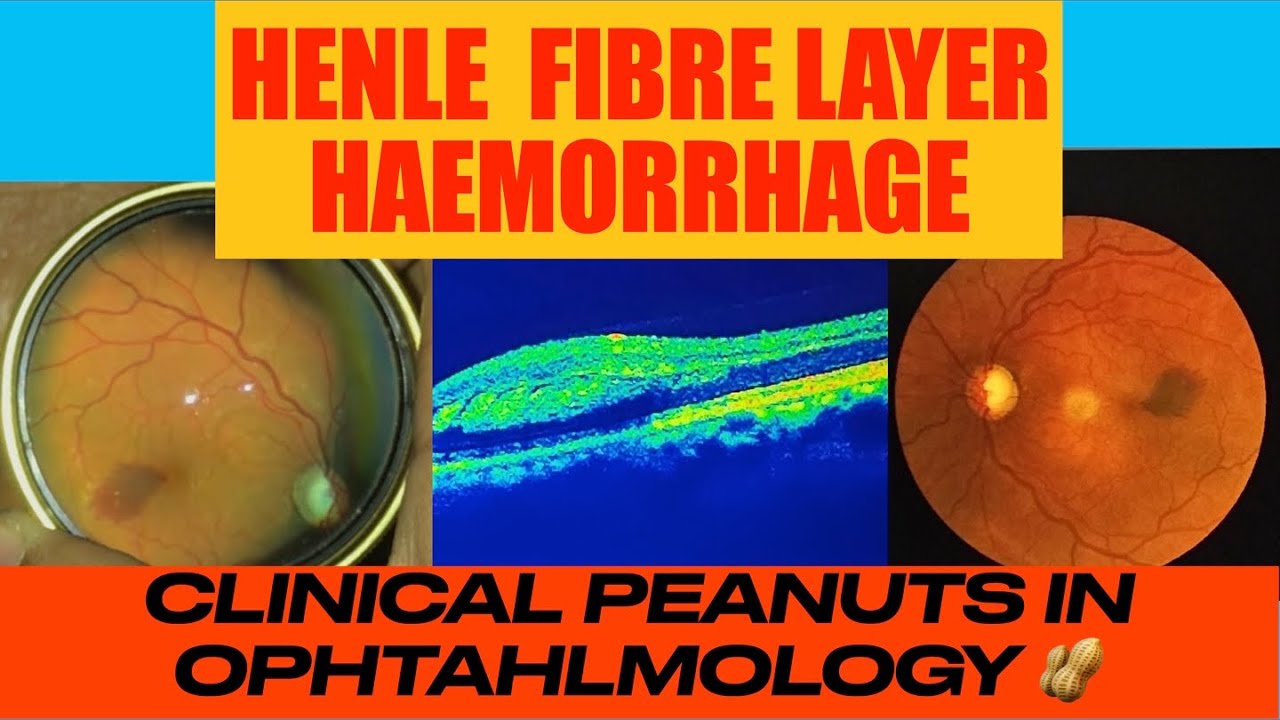 Understanding Henle Fibre layer Haemorrhage - YouTube