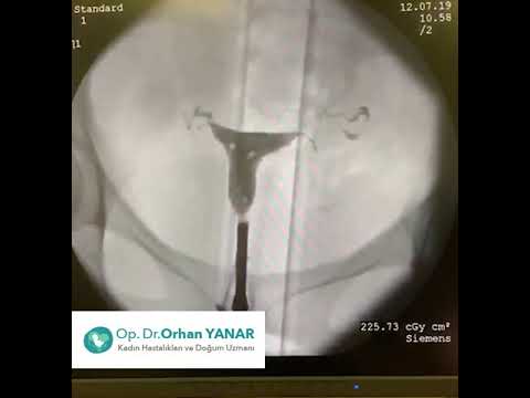 Anestezi ile rahim filmi (HSG)