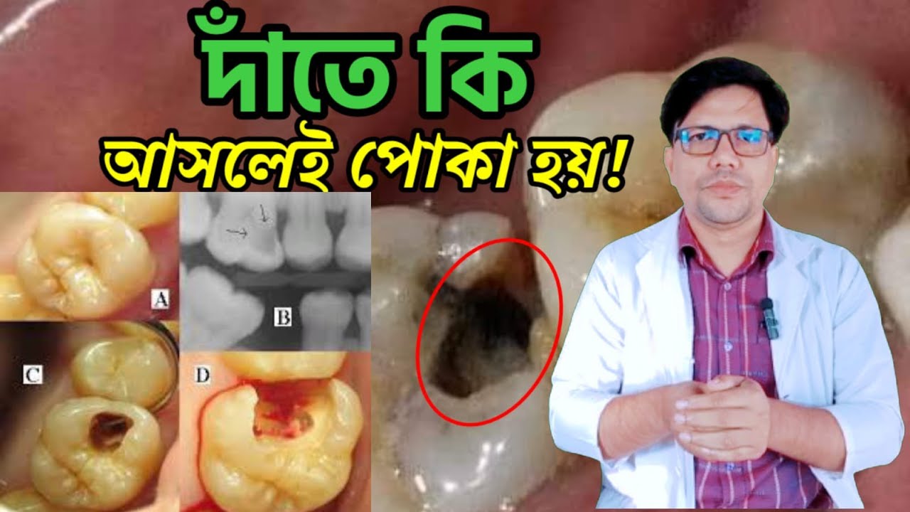 দাঁতে কি আসলে পোকা হয়। দাঁতে গর্ত, কালো দাগ দূর করার উপায়। daty koy ...