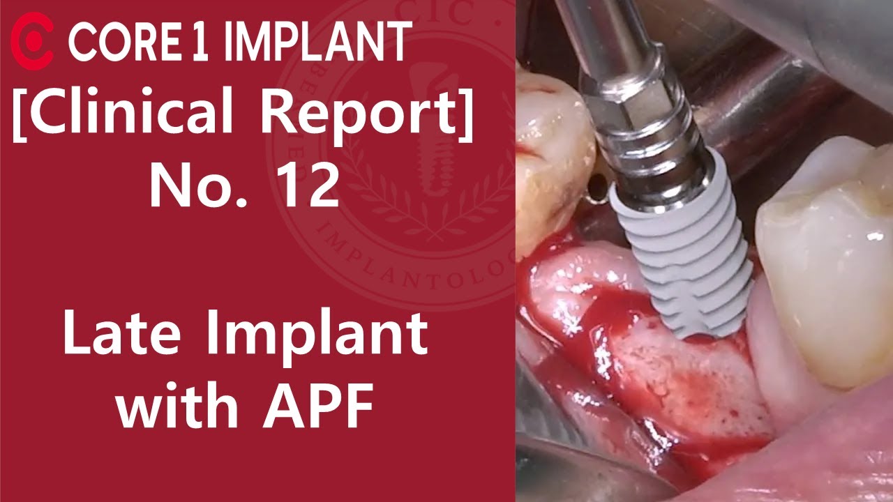 [CYBERMED Clinical Report] #46 Late implant placement with Apically ...