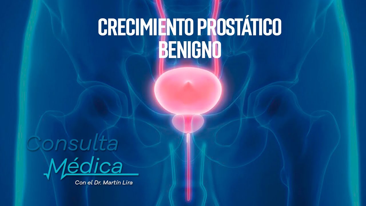 Crecimiento Benigno de Próstata | Consulta Médica | Programa 09 | SMRTV ...