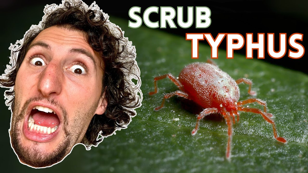 Scrub Typhus: Diagnosis & Management - YouTube