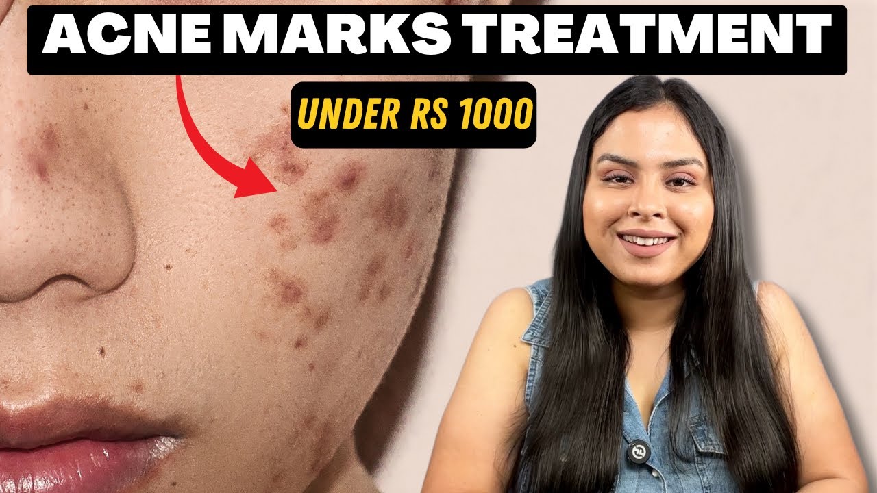 Treat pimple marks under Rs 1000 | How to get rid of acne marks PIH ...