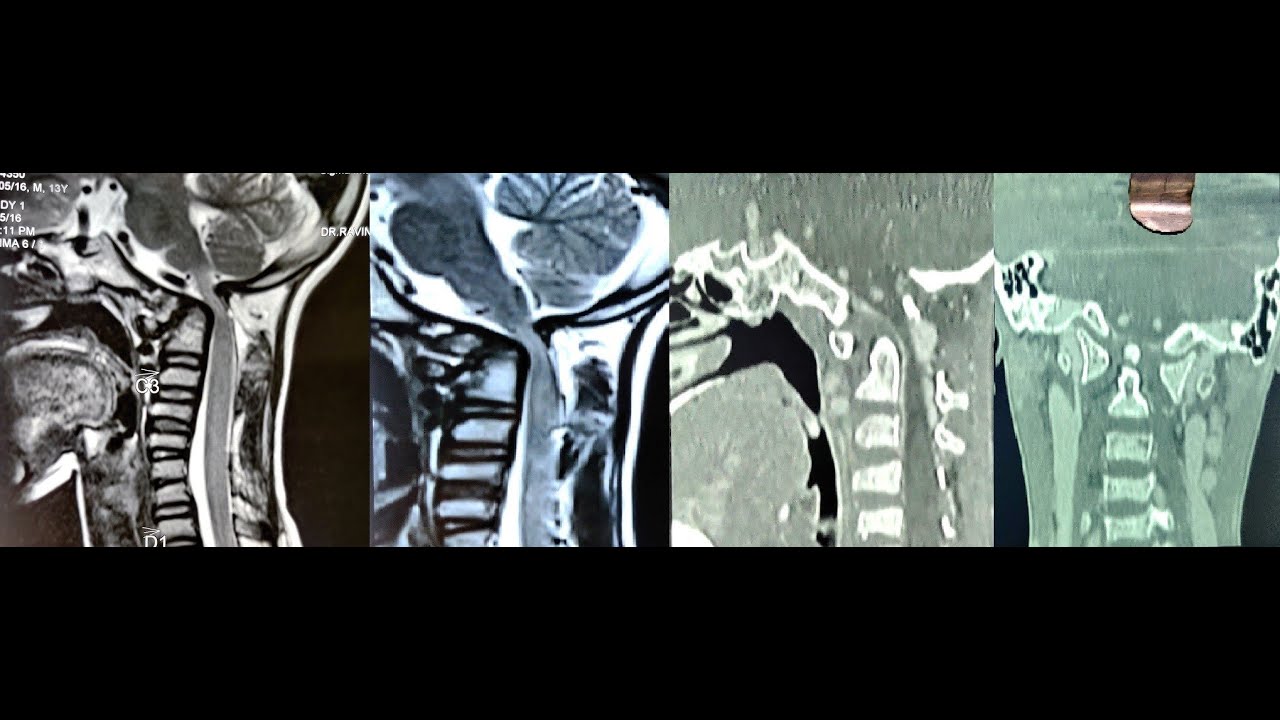 ATLANTO-AXIAL DISLOCATION-OS ODNTOIDIUM-C1-C2 POSTERIOR STABILISATION ...