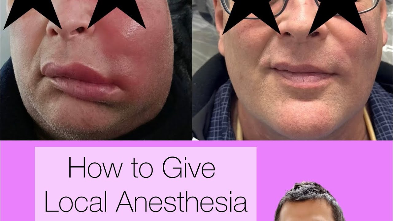 How to Give Local Anesthesia for this Abscess - YouTube