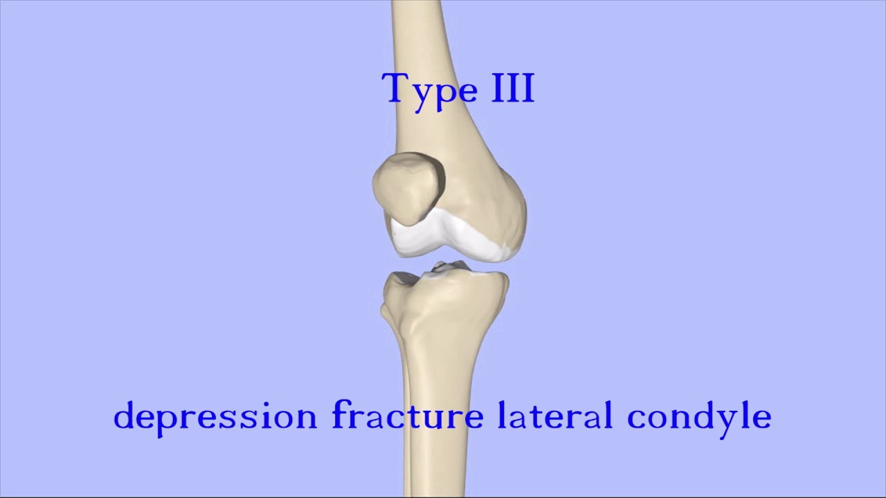 Tibial Plateau Fractures - YouTube